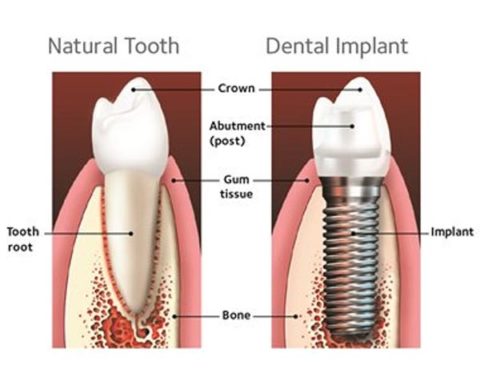 Dental Implants | Bel Air, MD | Lifetime Dental Care